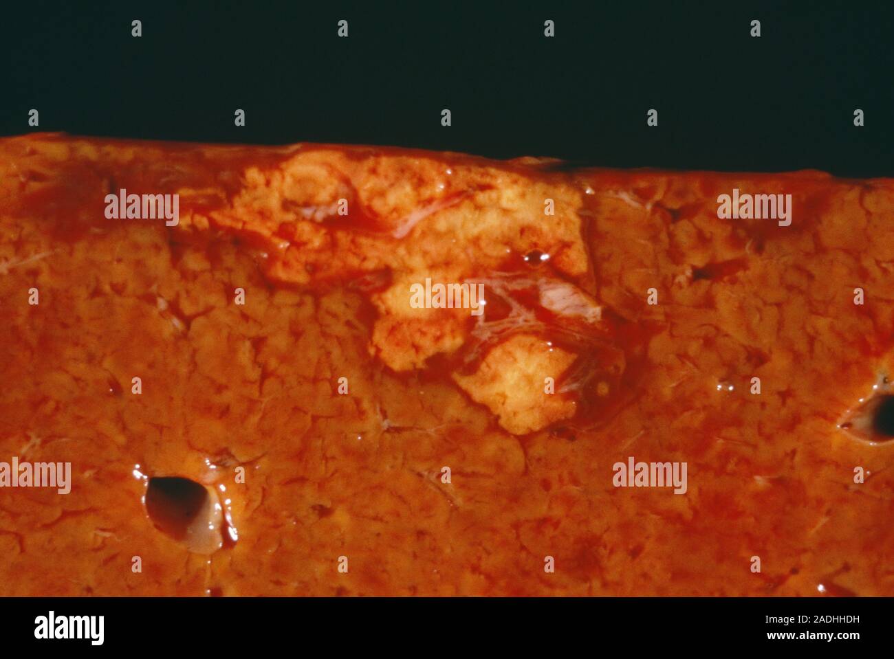 Dead liver tissue. Gross clinical specimen of a slice of liver tissue ...