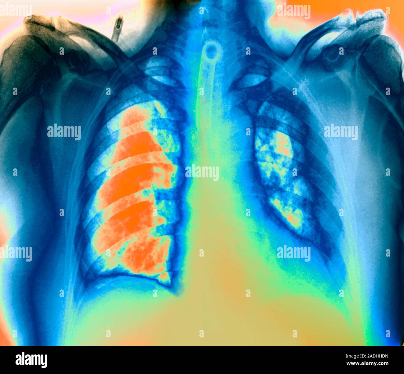 Pulmonary embolism. Coloured X-ray of the chest of a patient with a ...