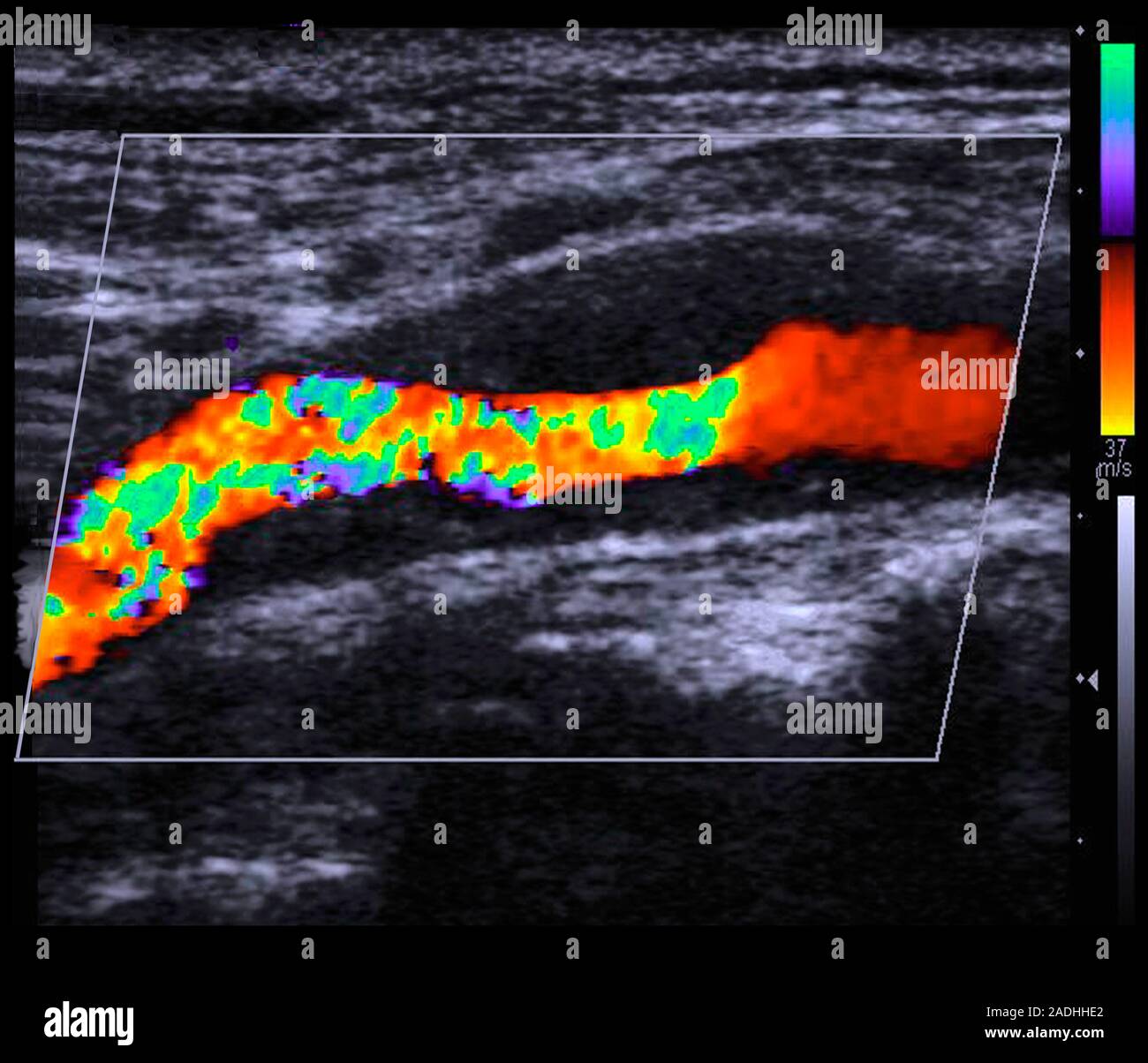 Atheroma plaque. Coloured doppler ultrasound scan of blood flow through ...