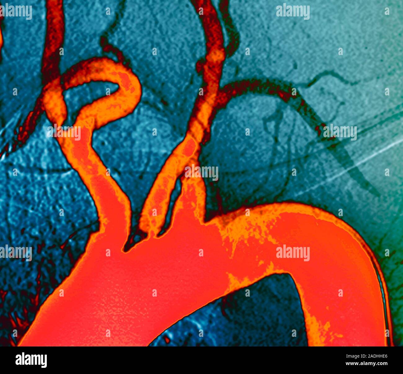Atheroma plaque. Coloured angiogram (blood vessel X-ray) of blood flow ...