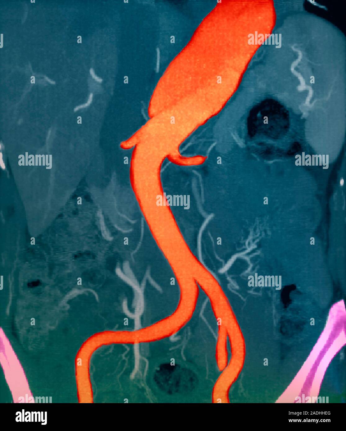 Aortic aneurysm. Coloured angio computed tomography (CT) scan of a ...