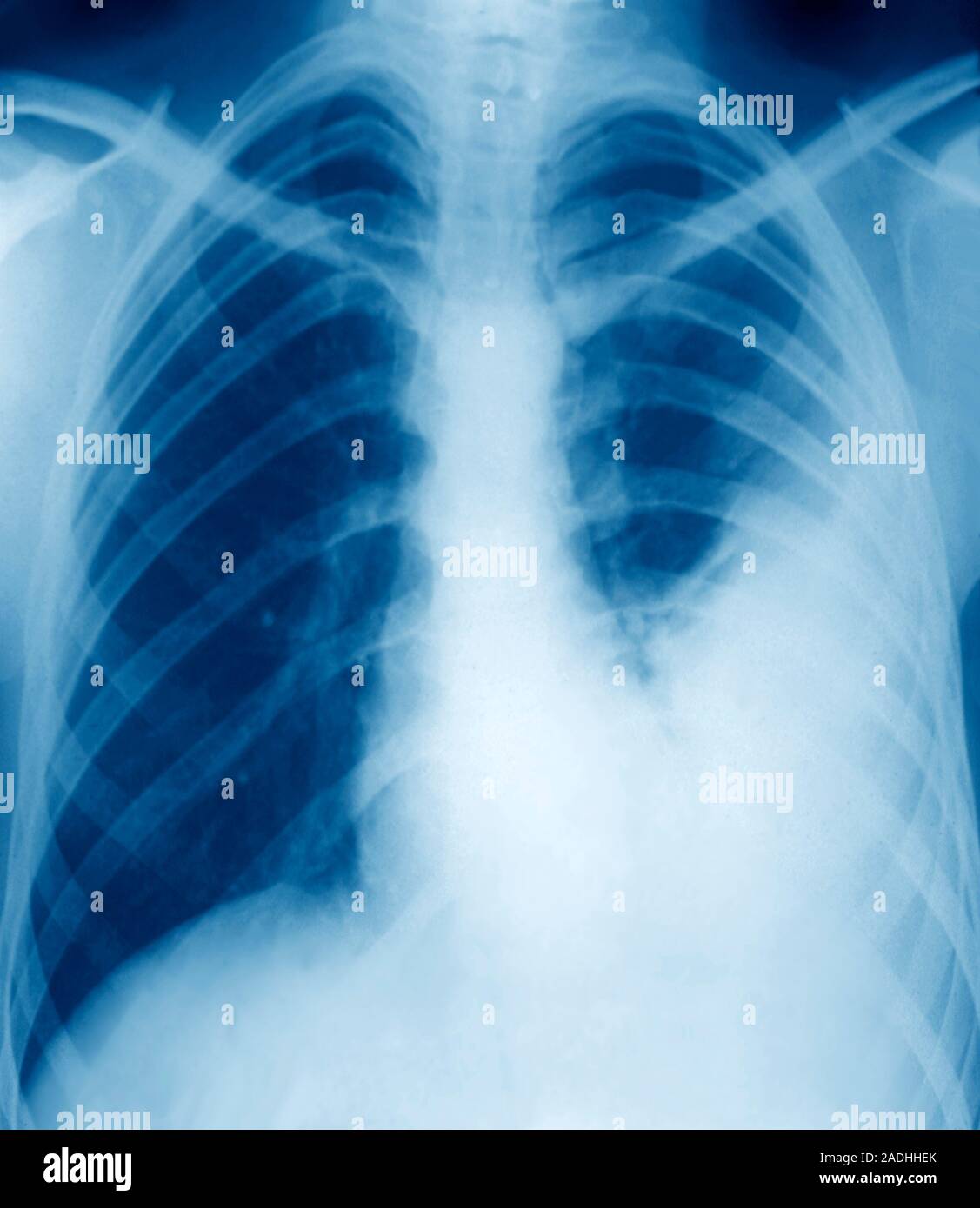 Pulmonary embolism. Coloured frontal X-ray of the chest of a patient ...