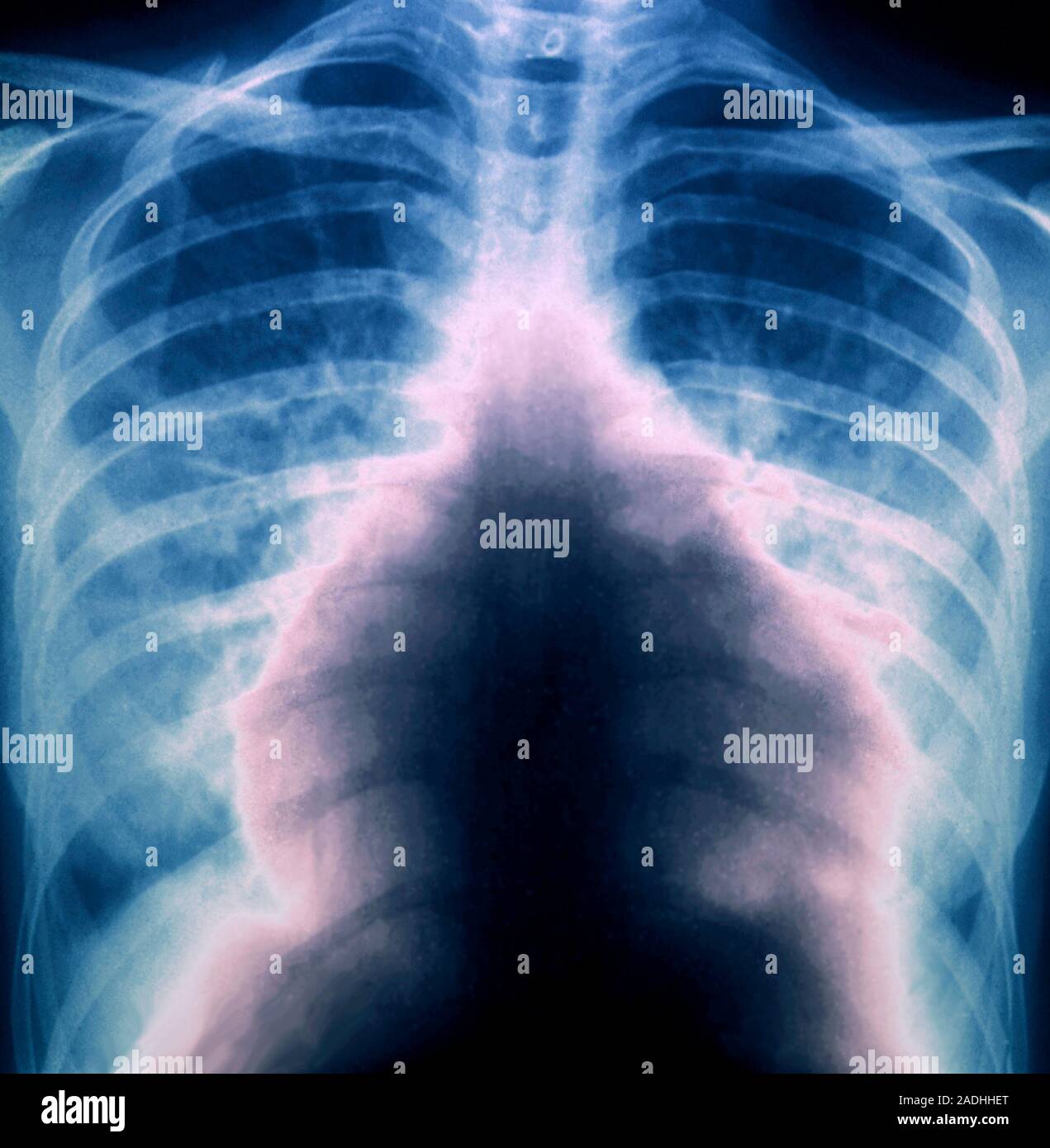 Pulmonary embolism. Coloured frontal X-ray of the chest of a patient ...