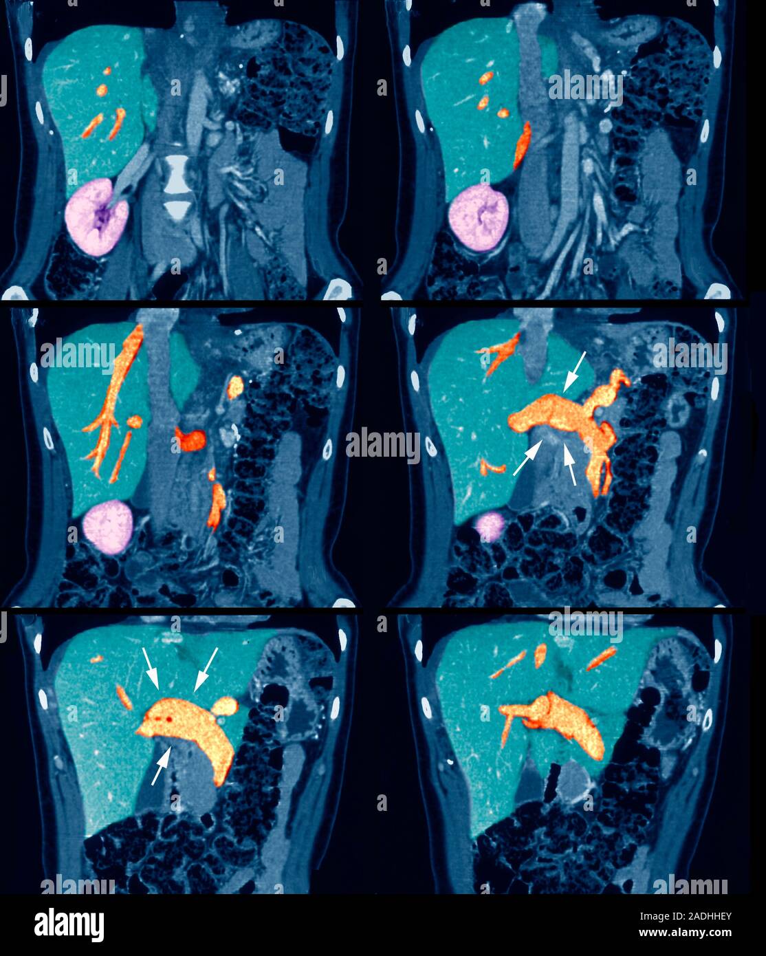 Portal vein thrombosis. Sequence of coloured frontal (coronal) angio computed tomography (CT ...