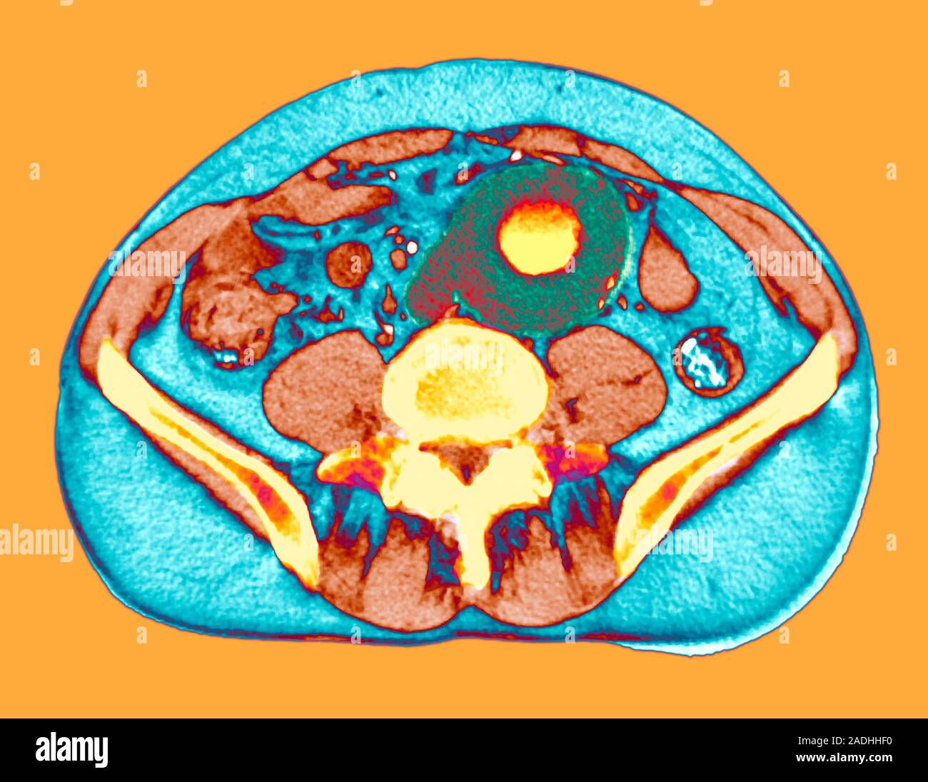 Aortic aneurysm. Coloured computed tomography (CT) scan of an axial section of a patient's ...