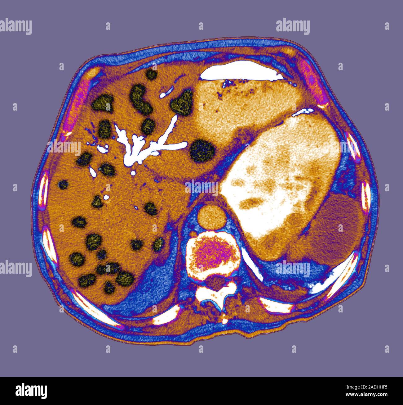 Liver cancer. Coloured computed tomography (CT) scan through the abdomen of a patient with ...