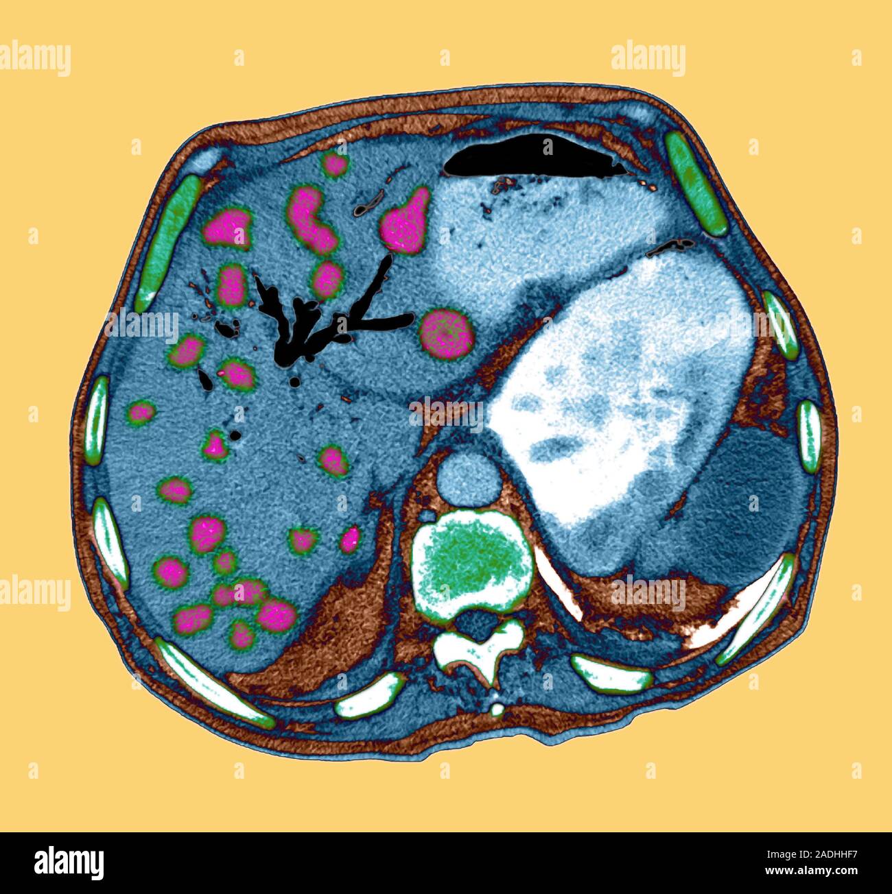 Liver cancer. Coloured computed tomography (CT) scan through the ... Liver cancer. Coloured computed tomography (CT) scan through the ...