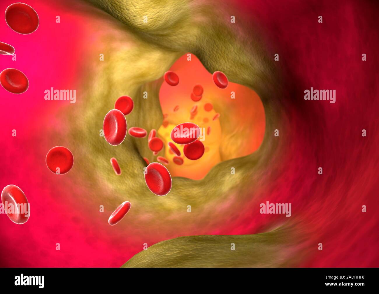 Artery disease. Computer artwork of blood cells (round) in an artery ...