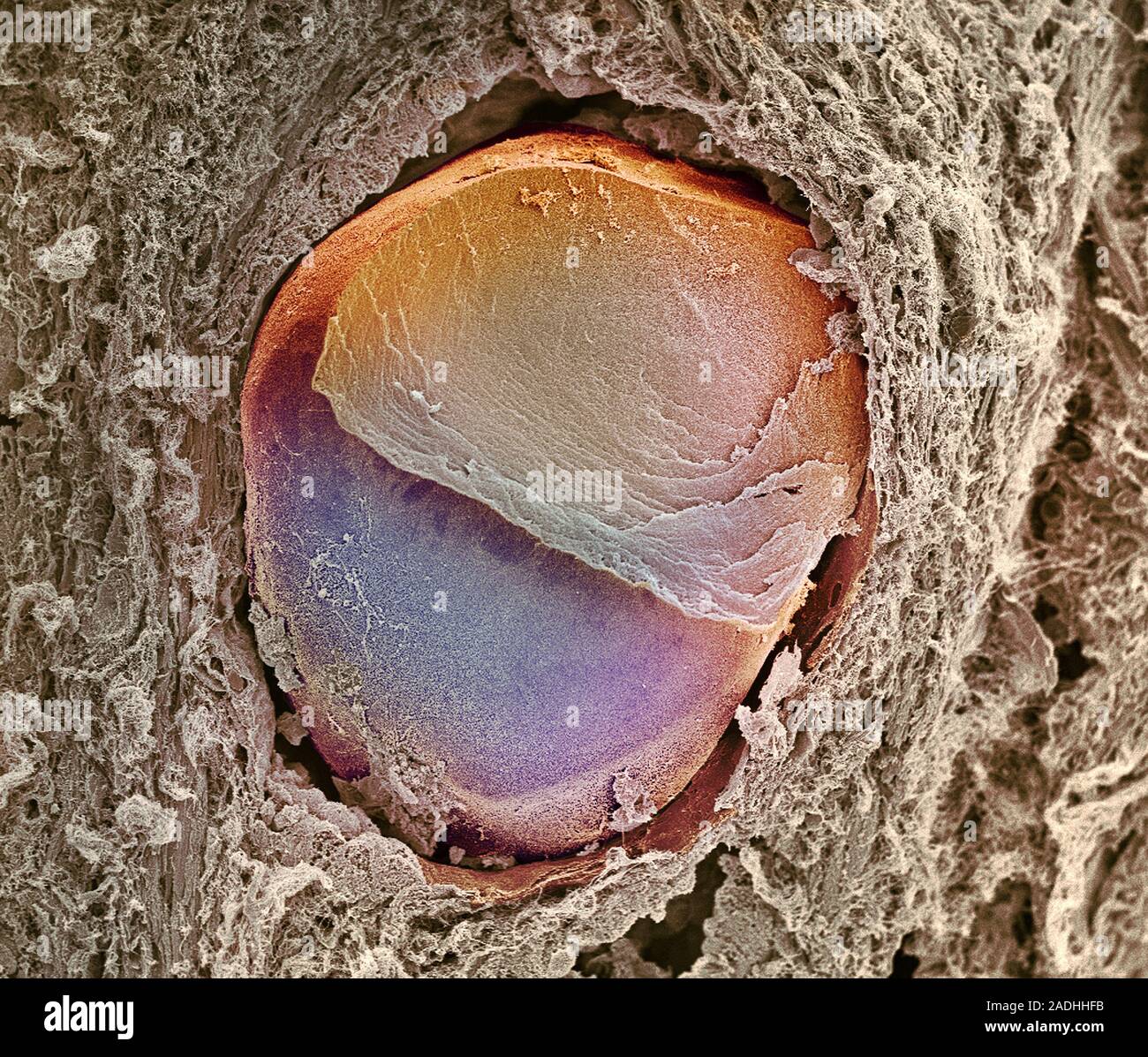 Embolism. Coloured scanning electron micrograph (SEM) of a blockage, or ...