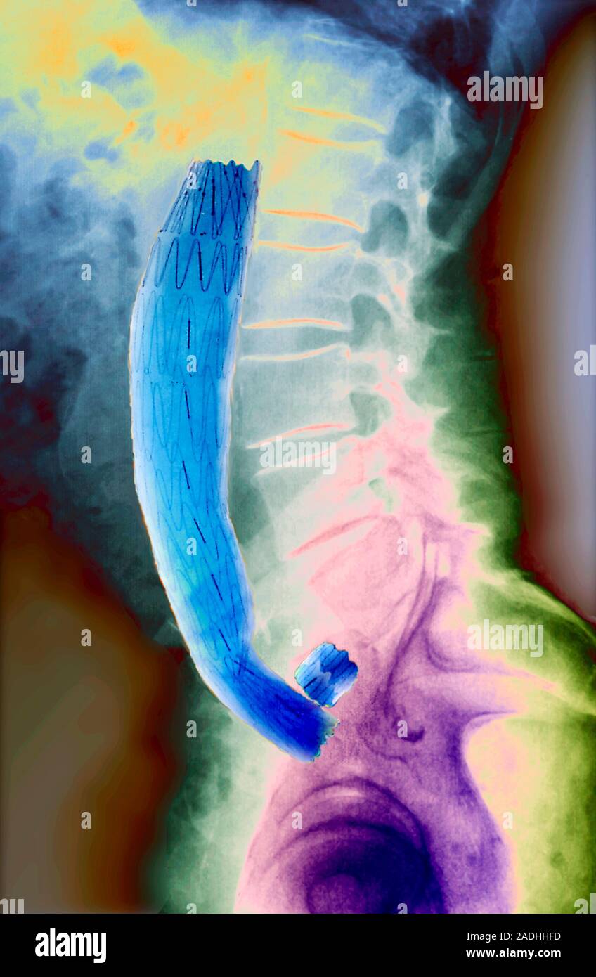 Abdominal aortic aneurysm. Sagittal coloured X-ray of a 60 year old ...