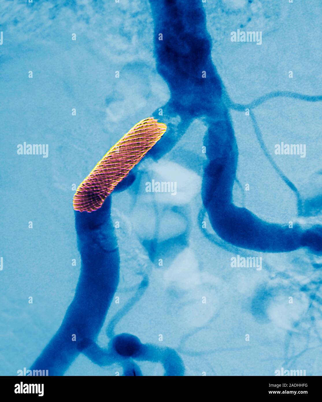 Arterial stent. Coloured X-ray of a stent (orange) in a patient with ...