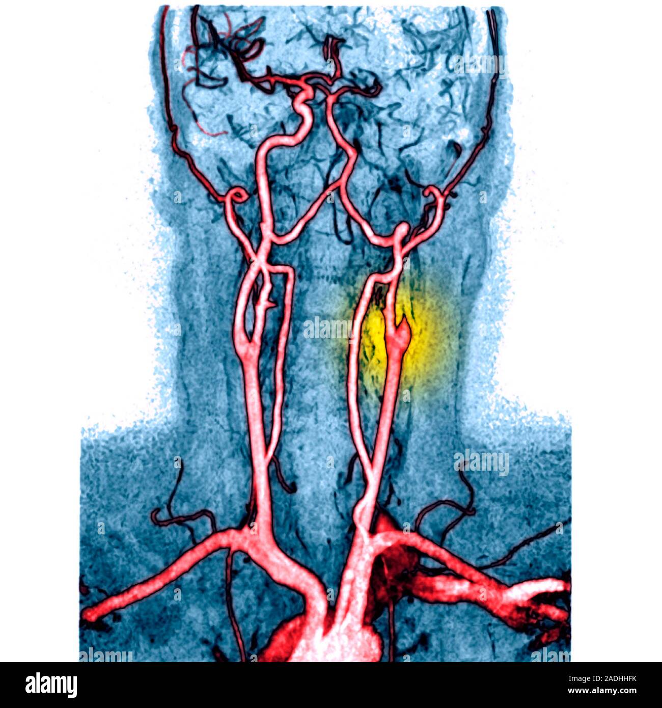 Blocked artery. Coloured magnetic resonance angiogram of a coronal ...