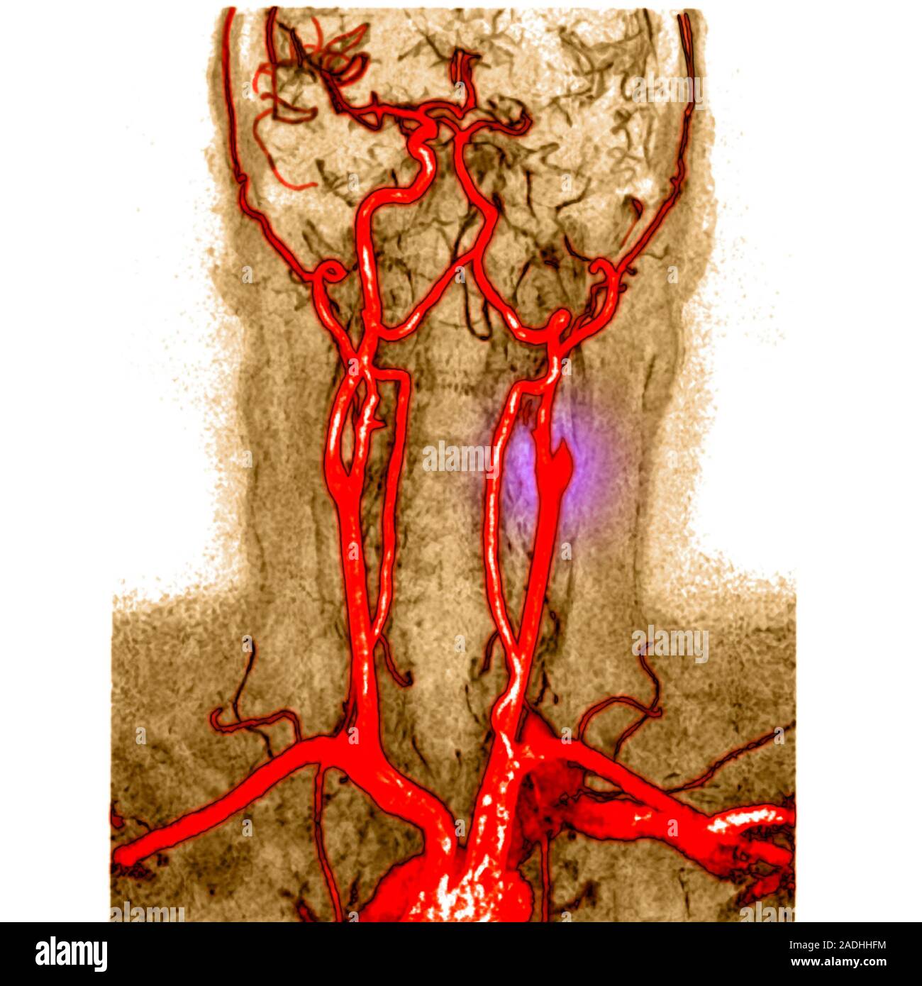Blocked artery. Coloured magnetic resonance angiogram of a coronal ...