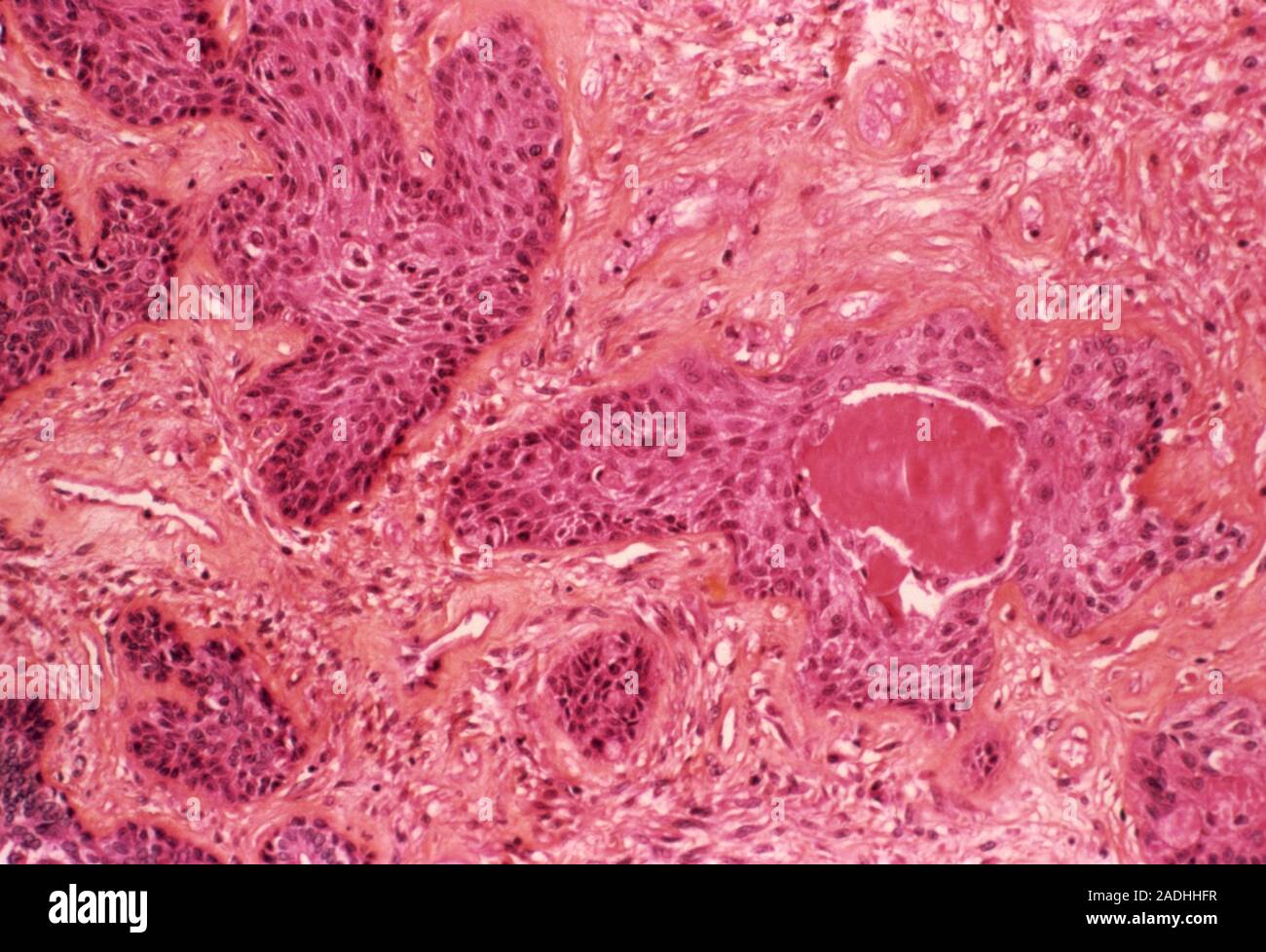Prostate blood clot. Light micrograph of a blood clot (centre right ...