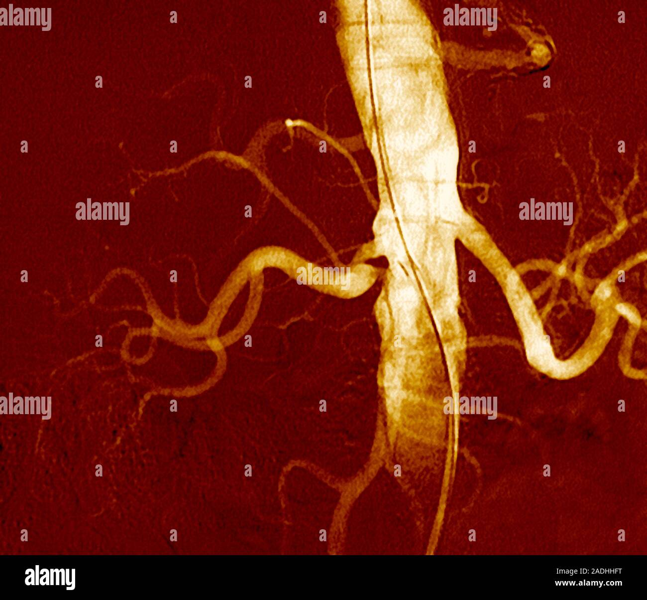 Narrowed renal artery. Coloured angiogram X-ray of the abdomen of a 62 ...