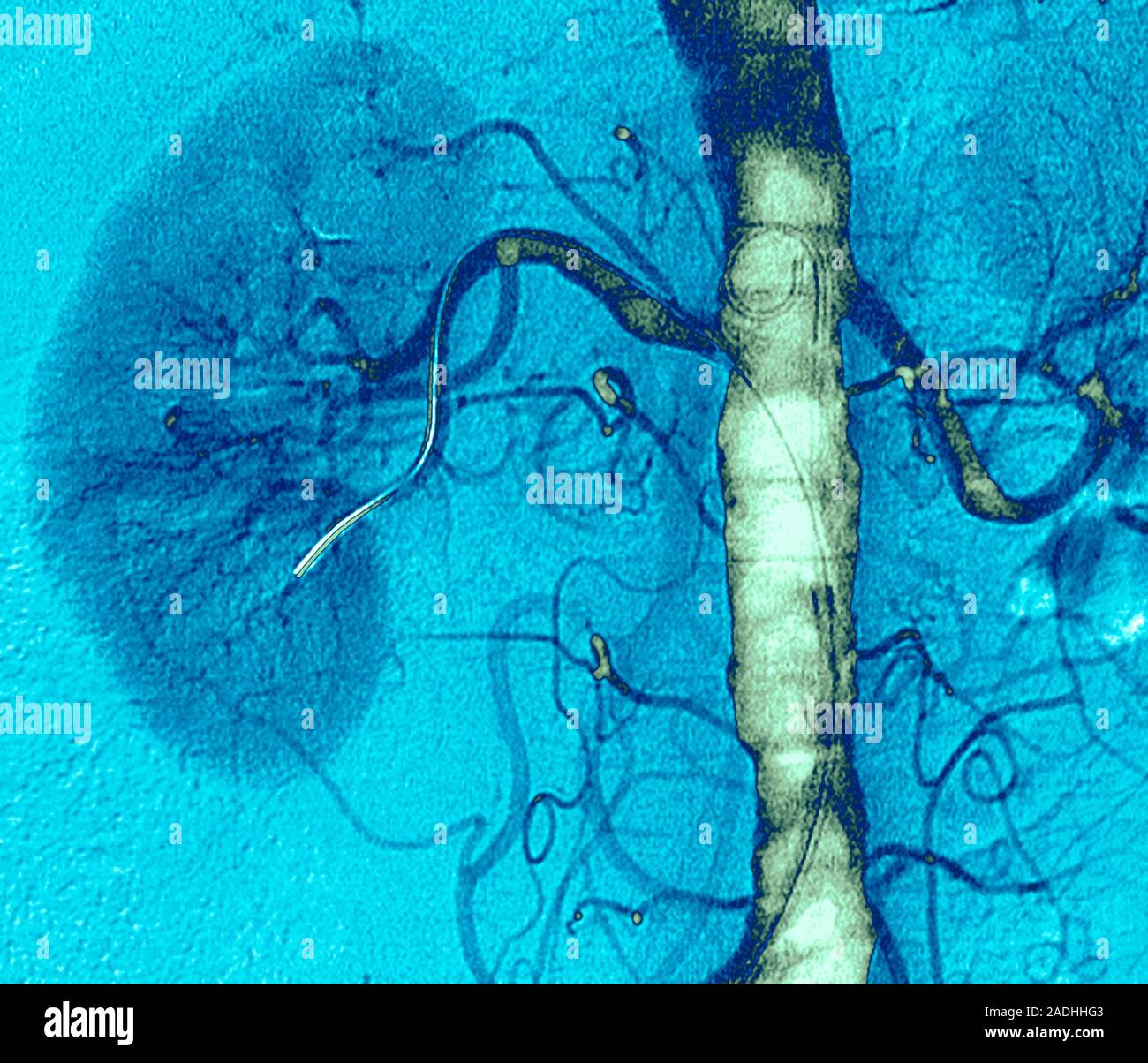 Arterial stent. Coloured X-ray angiogram of a stent (light blue line ...