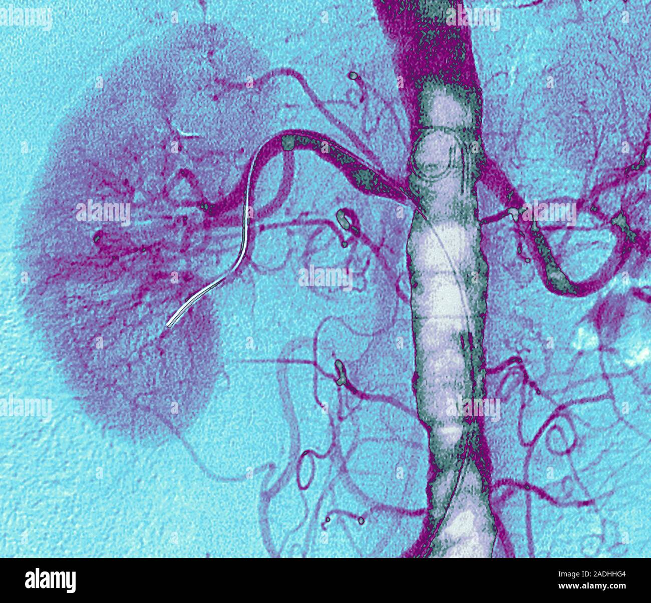 Arterial stent. Coloured X-ray angiogram of a stent (white line, left ...