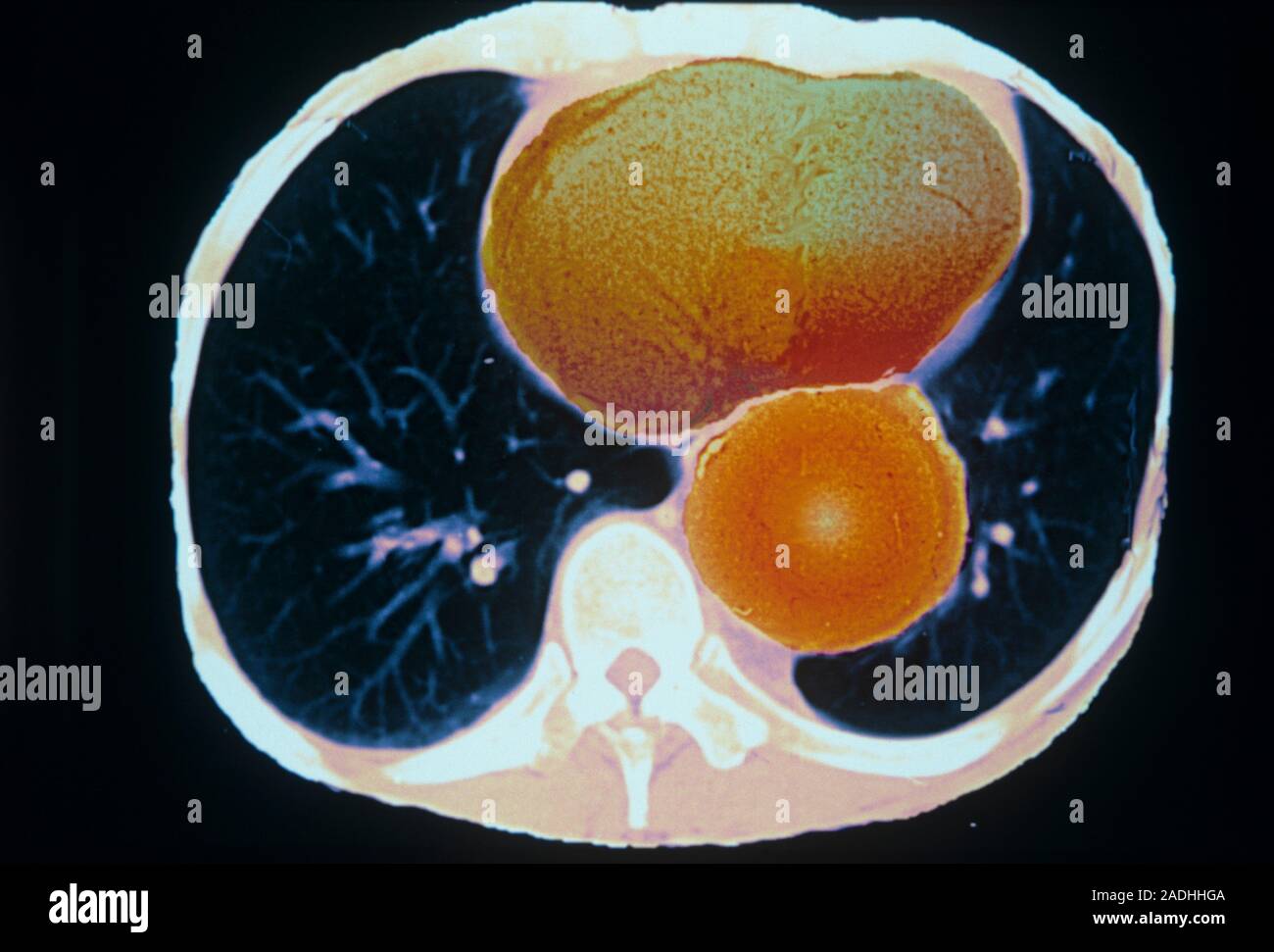 Aortic aneurysm. Coloured computed tomography (CT) scan of a thoracic ...