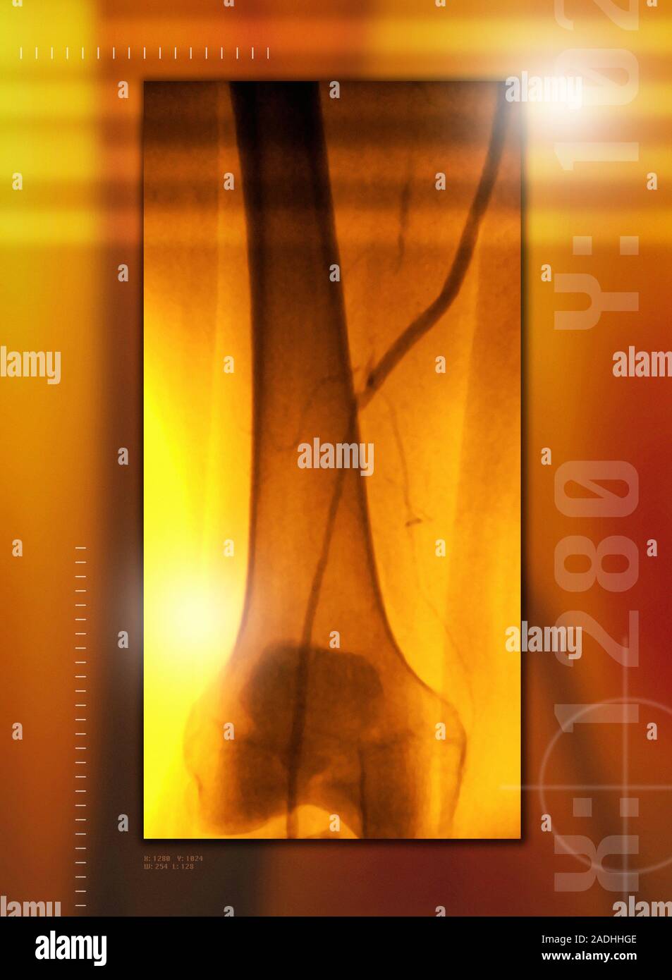 Femoral artery bypass, coloured angiogram X-ray. The femoral artery ...