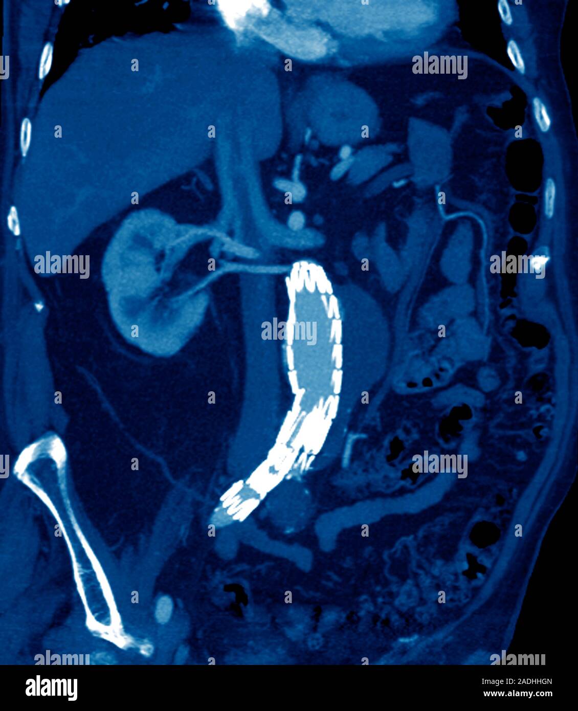 Abdominal aortic aneurysm. Oblique coloured computed tomography (CT ...
