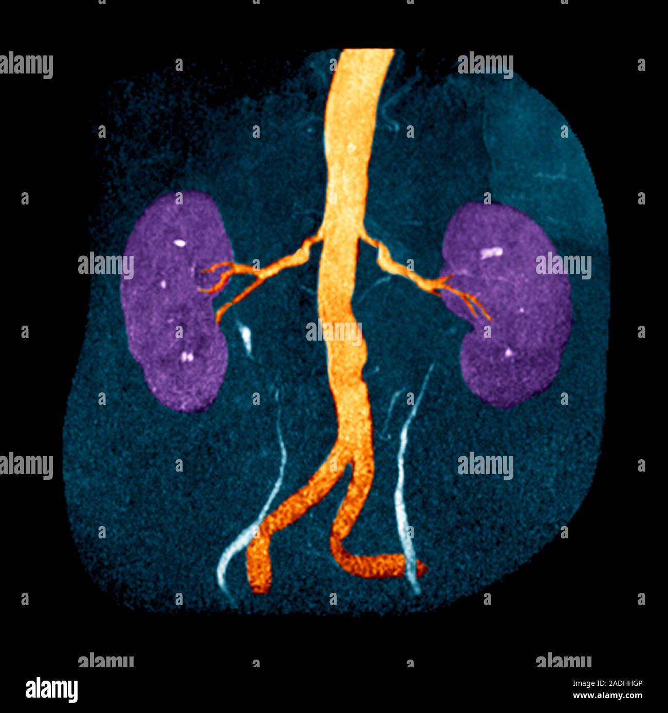 Narrowed renal arteries. Coloured magnetic resonance imaging (MRI) scan ...