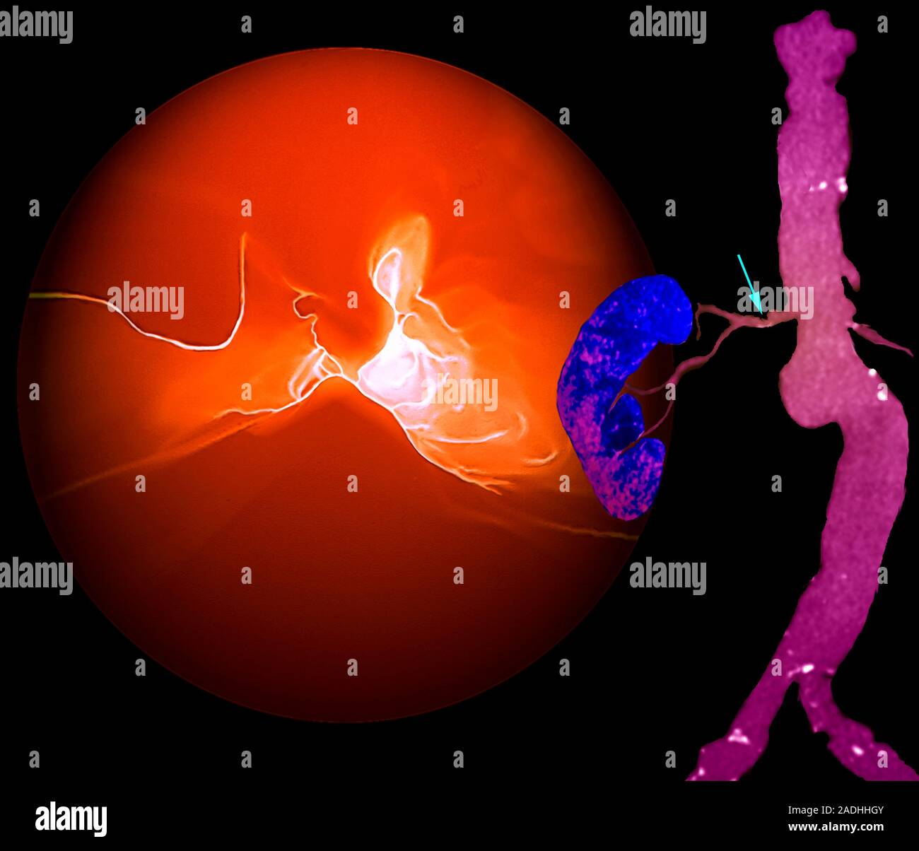 Narrowed renal artery. Coloured computed tomography (CT) scans from a ...