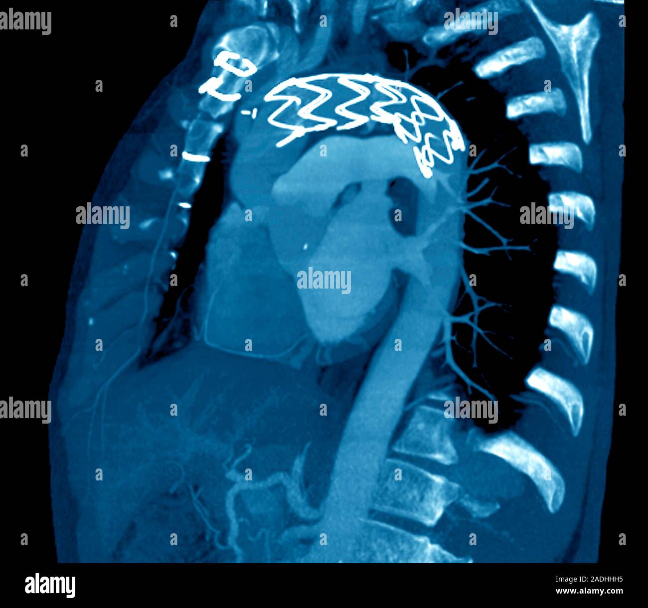 Stent in a dissecting aorta. Coloured sagittal computed tomography (CT ...