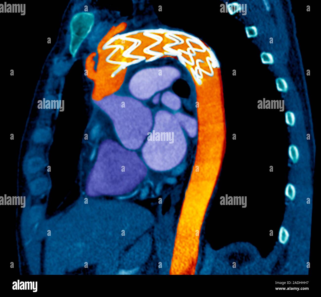 Stent in a dissecting aorta. Coloured sagittal computed tomography (CT) scan of the aorta of a ...