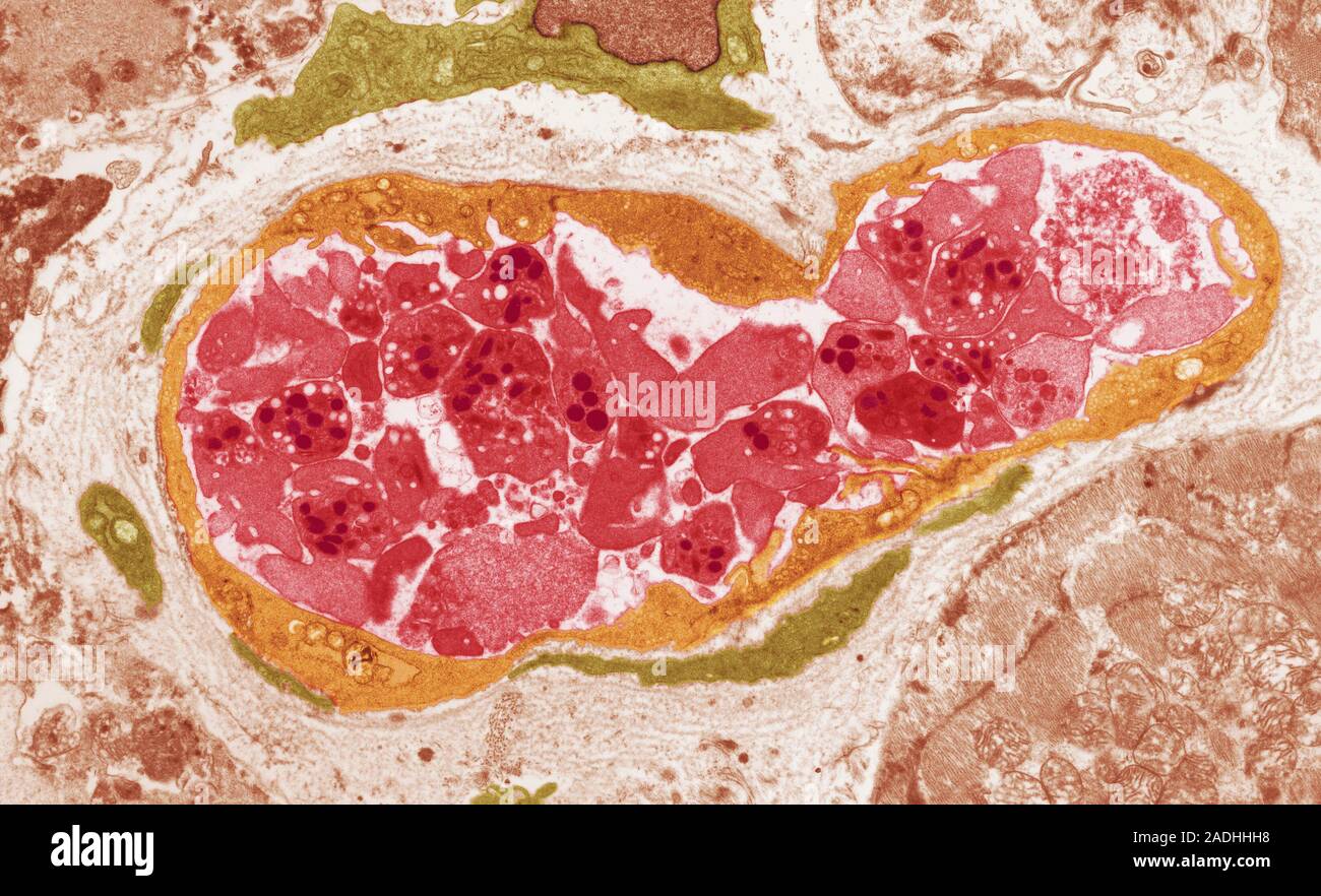 Abnormal blood clot. Coloured transmission electron micrograph (TEM) of ...