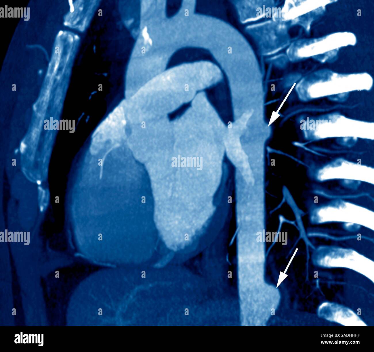 Aortic aneurysms. Coloured computed tomography (CT) scan of the chest ...