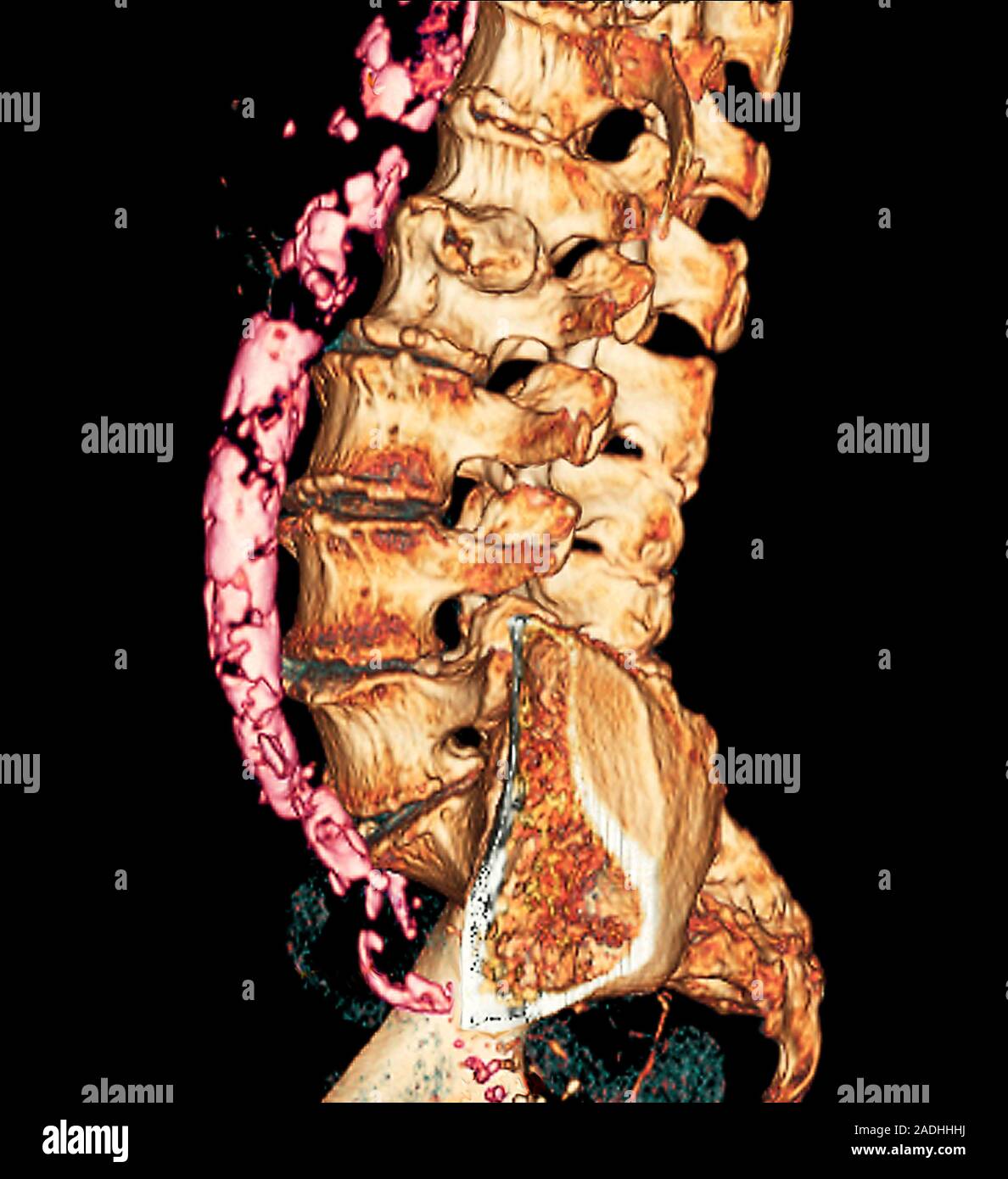 Atheroma plaques. Coloured 3D profile computed tomography (CT) scan of ...