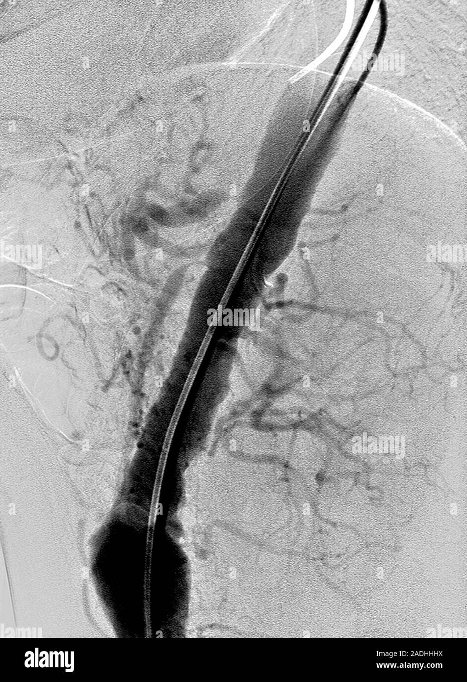 Narrowed arteries. Fluoroscope (X-ray) of the abdomen of a patient with ...