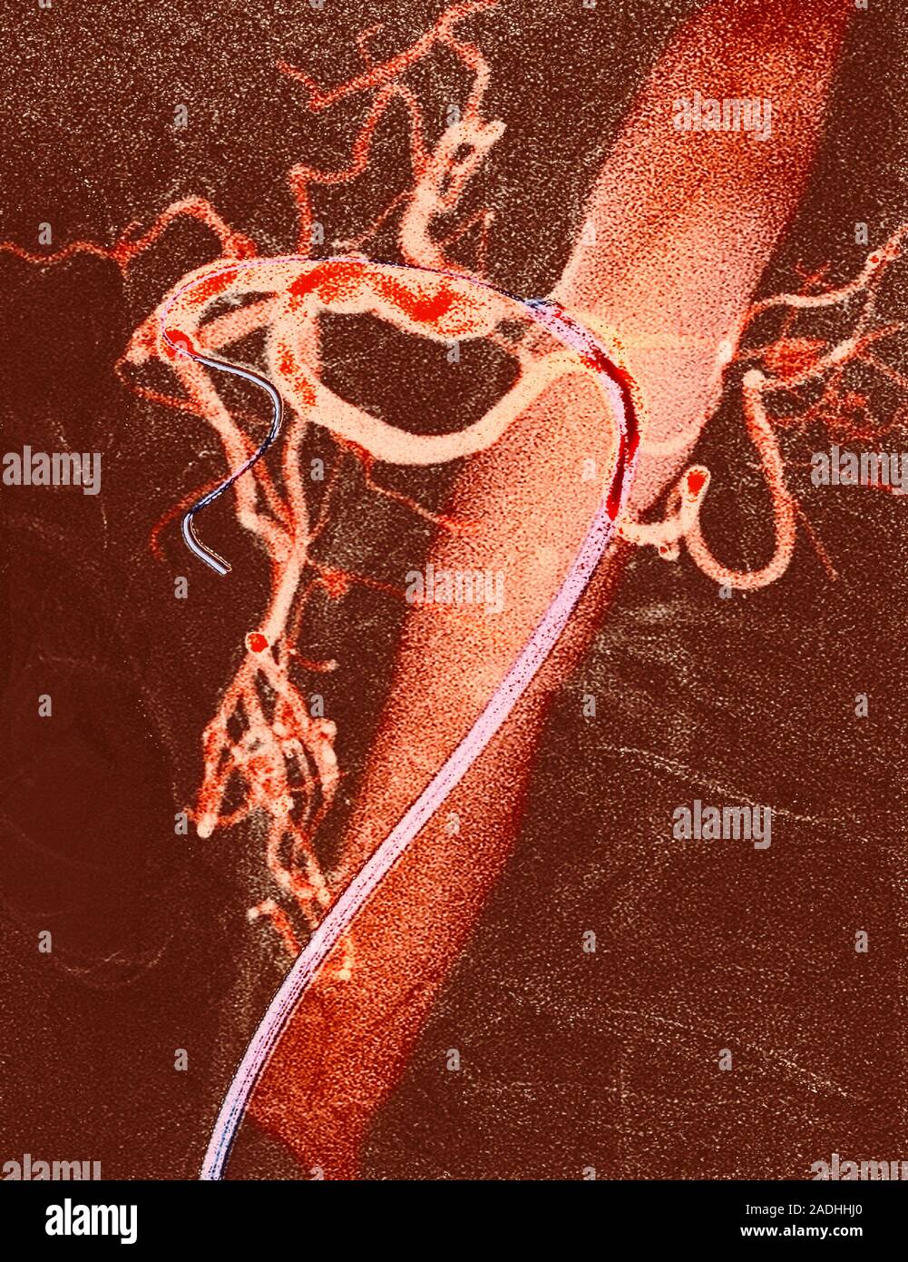 Balloon angioplasty. Coloured X-ray of a balloon catheter being placed ...