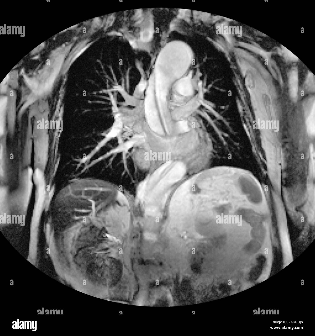 Dissecting aorta. 3D magnetic resonance imaging (MRI) scan of the chest ...