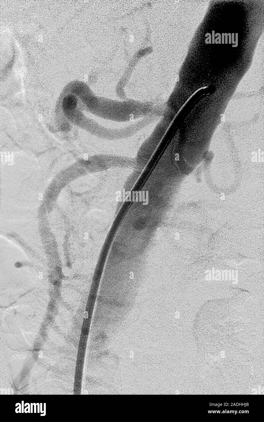 Arterial stents. X-ray of the abdomen of a patient with stents (wire ...