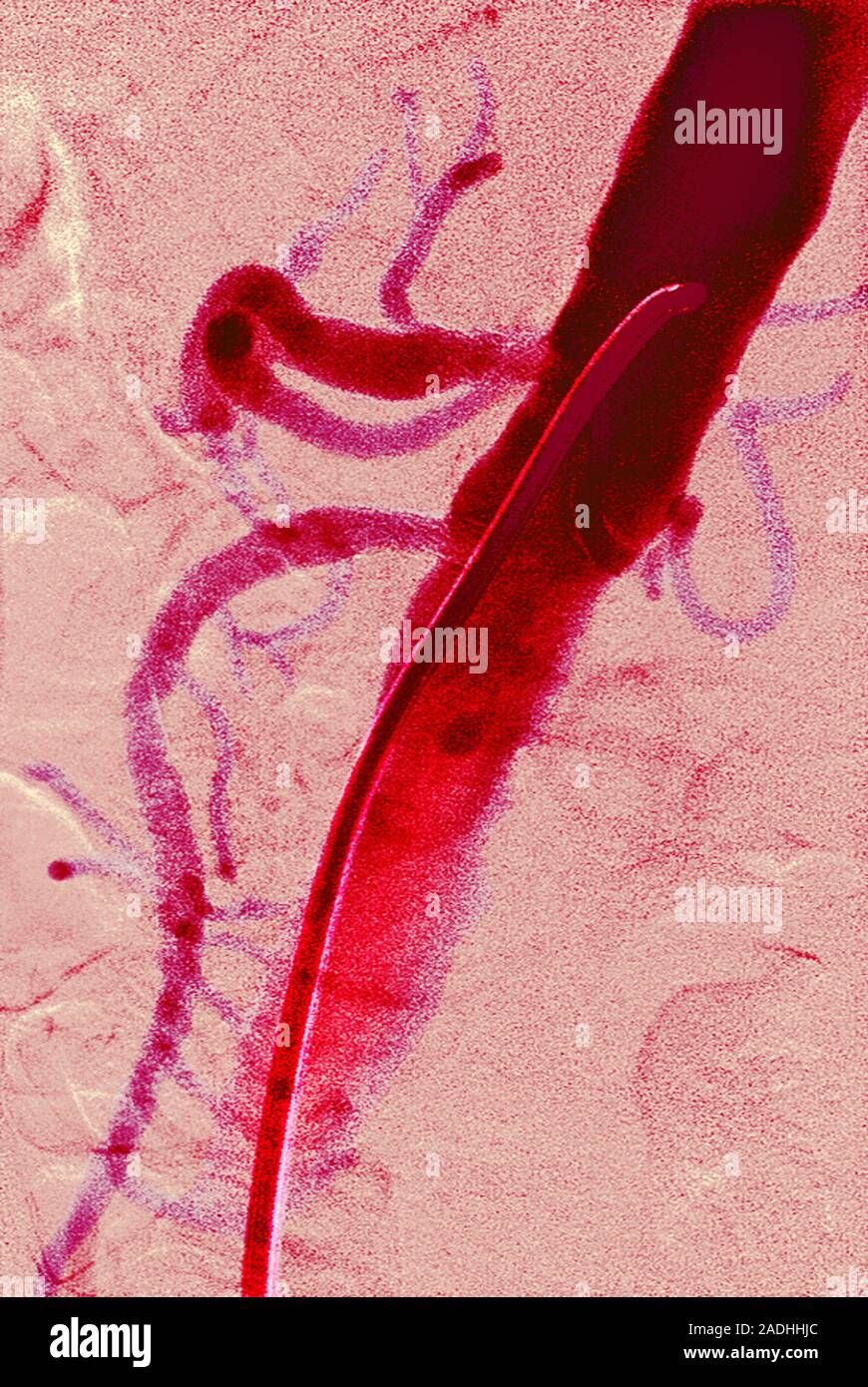 Arterial stents. Coloured X-ray of the abdomen of a patient with stents ...