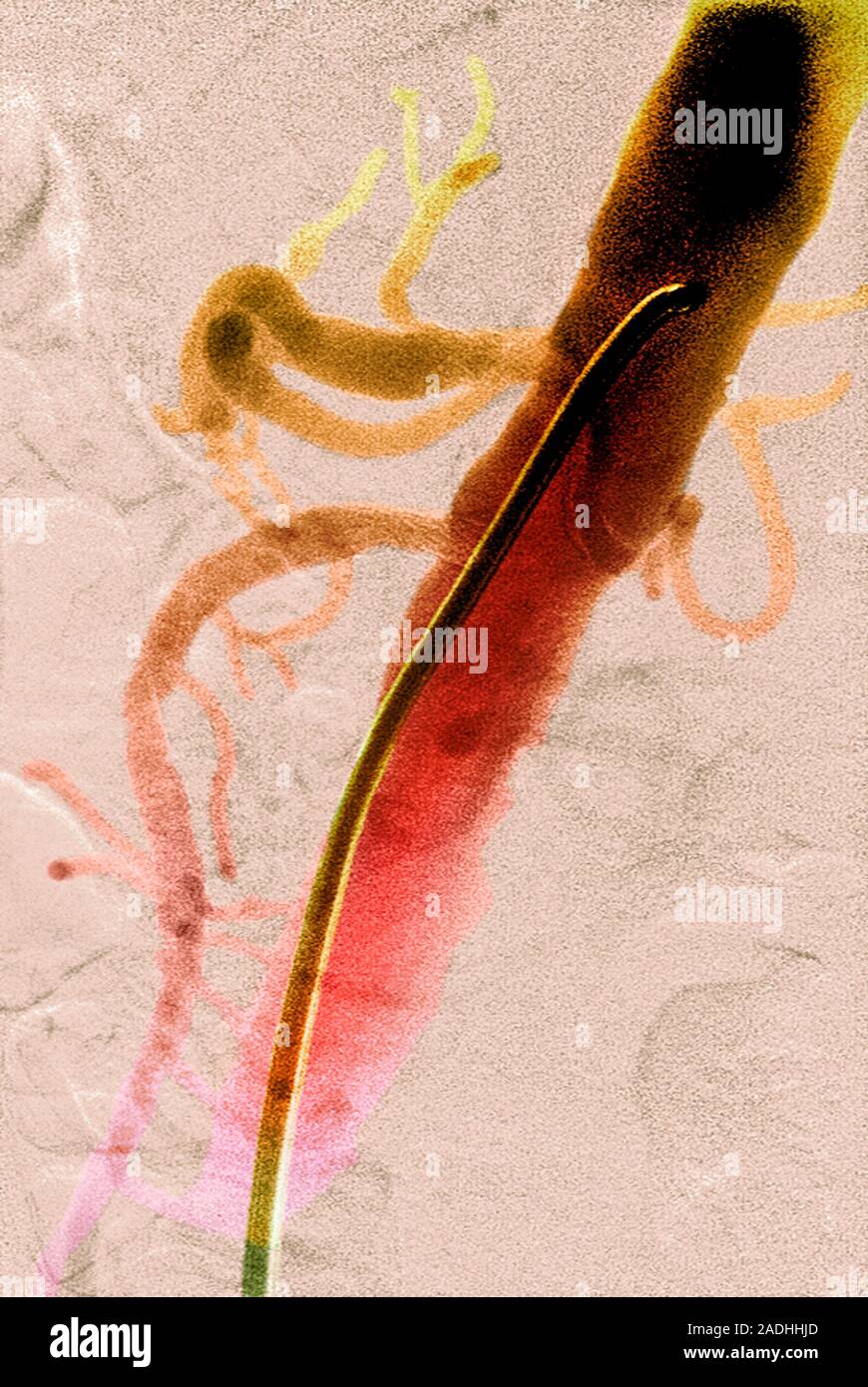 Arterial stents. Coloured X-ray of the abdomen of a patient with stents ...