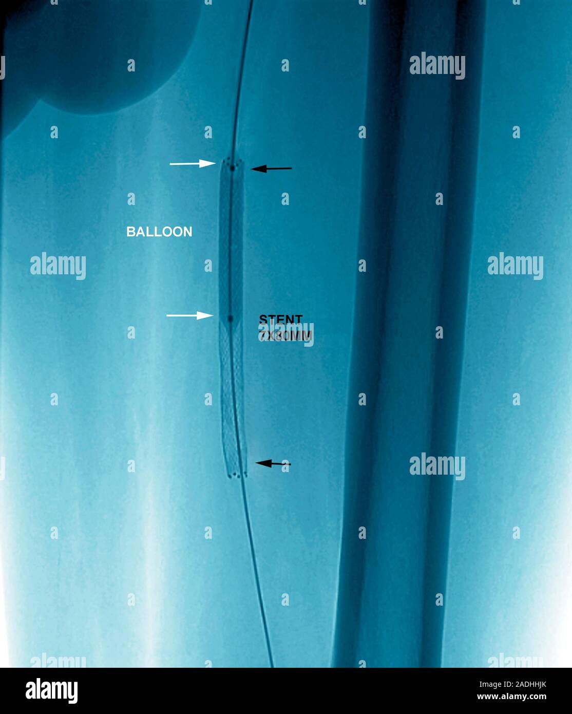 Femoral artery angioplasty. Coloured angiogram of a balloon catheter ...