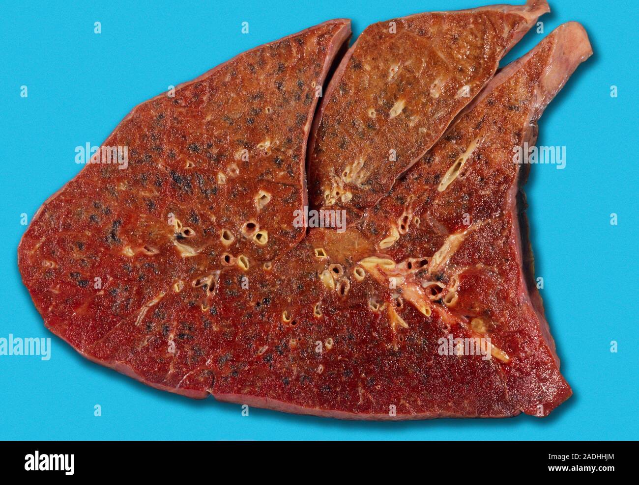 Atheroma of vessels of the lung, gross specimen. Atheroma is the ...
