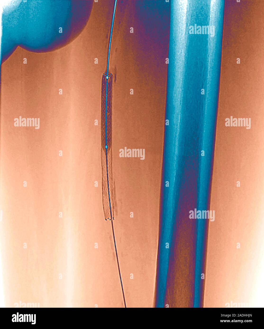 Femoral artery angioplasty. Coloured angiogram of a balloon catheter ...