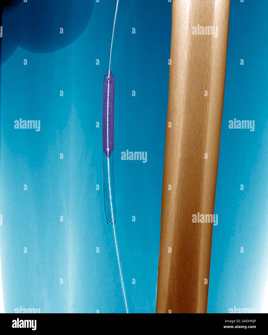 Femoral artery angioplasty. Coloured angiogram of a balloon catheter ...