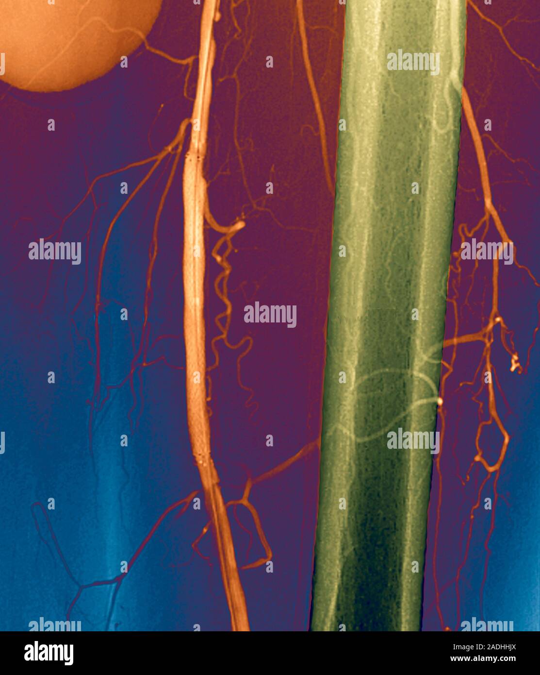 Stent in a femoral artery. Angiogram of a stent in the left femoral ...