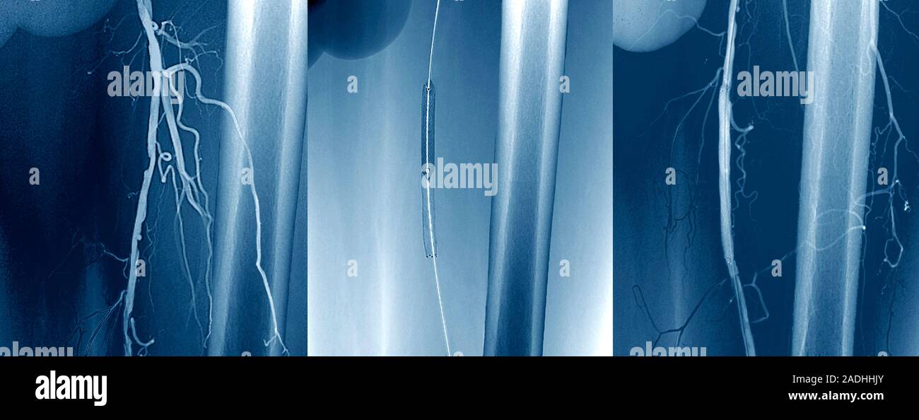 Treatment of a narrowed femoral artery. Coloured angiograms showing ...