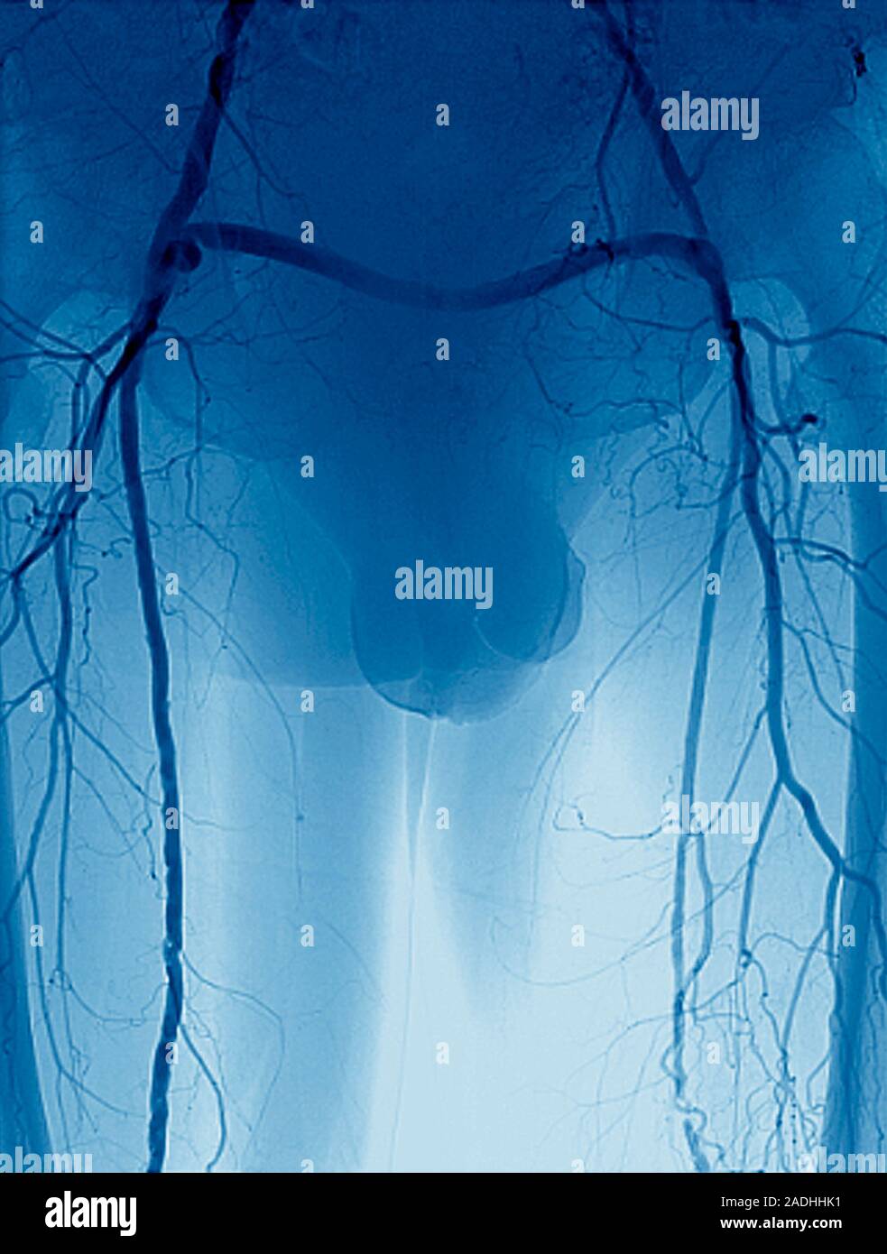 Arterial bypass. Coloured angiogram showing a grafted artery (upper ...