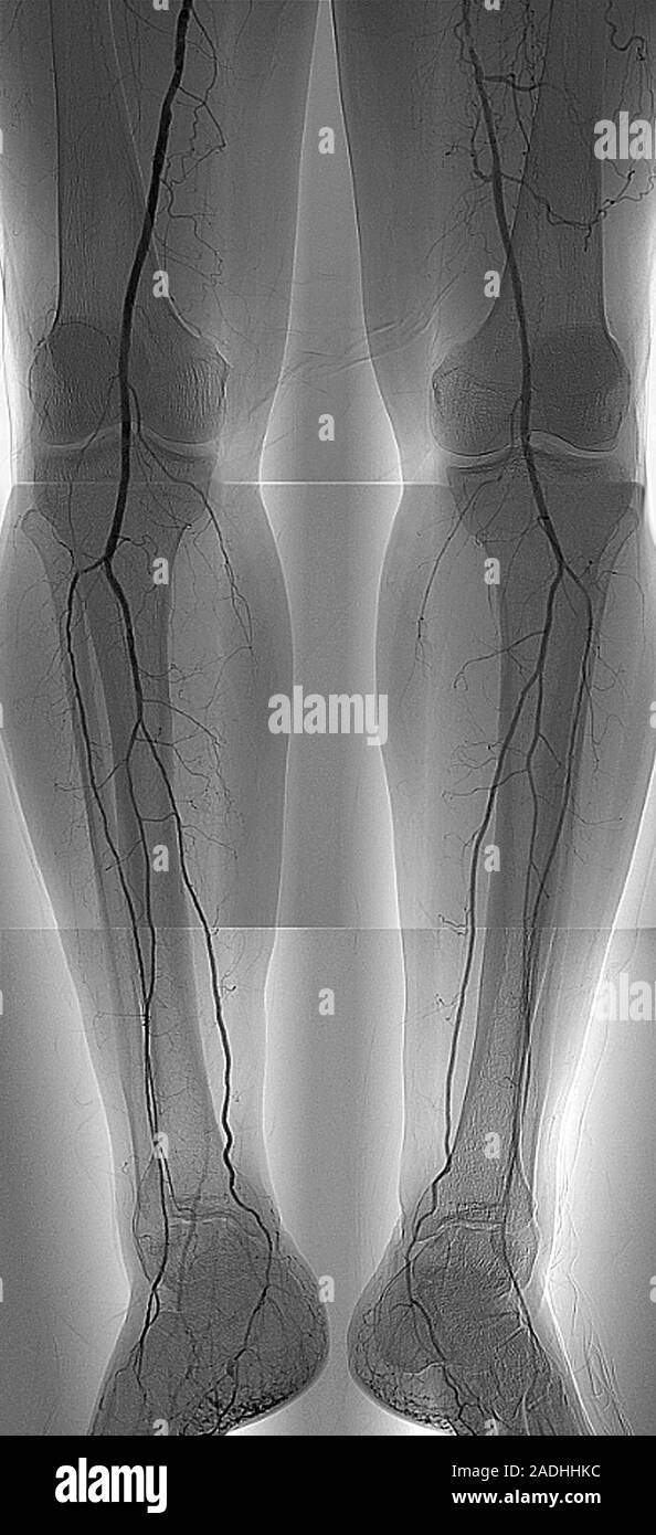 Narrowed leg arteries. Angiogram of the legs of a 66-year-old man ...