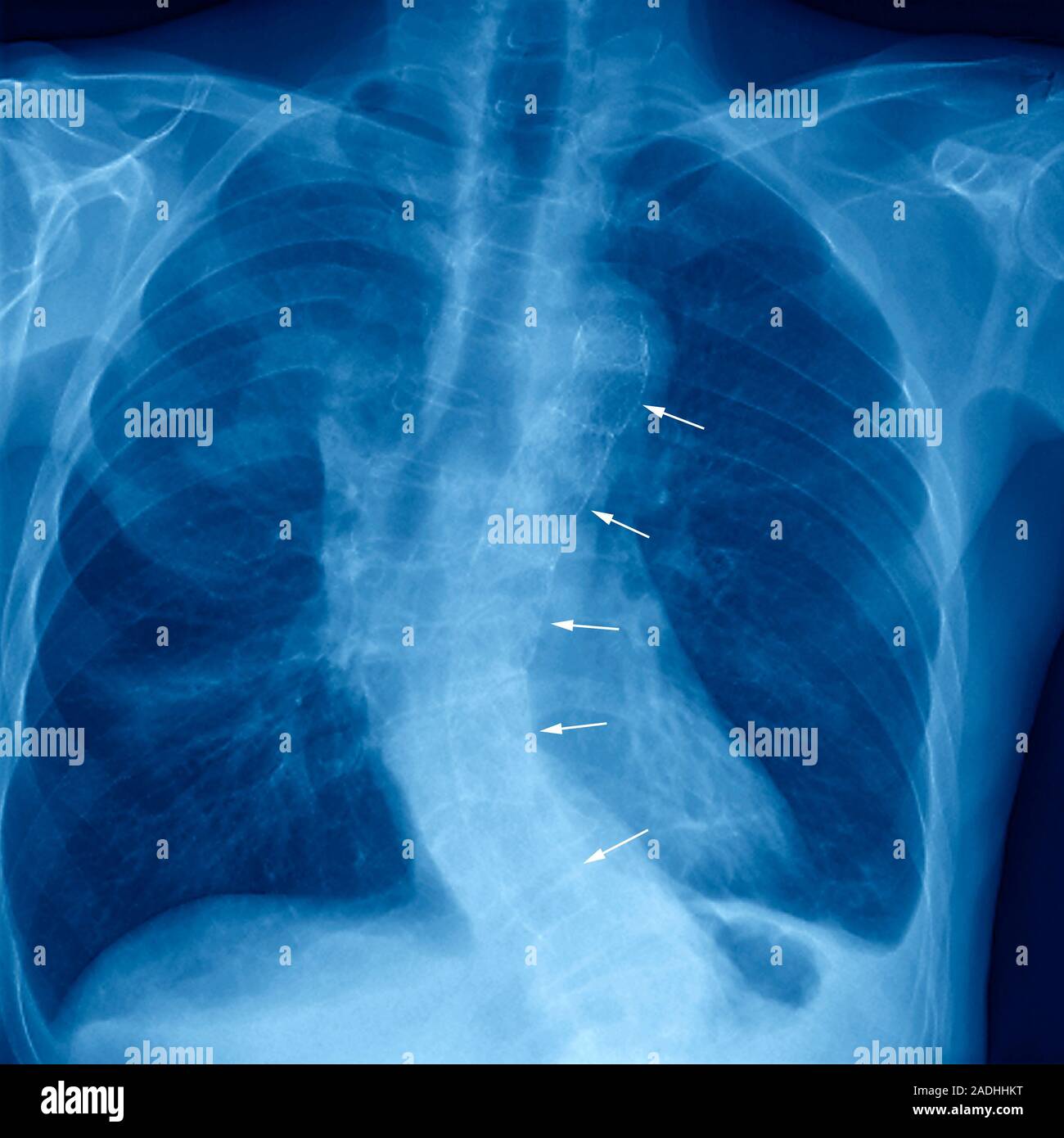 Stent in thoracic aorta. Frontal coloured angiogram of a stent in the ...