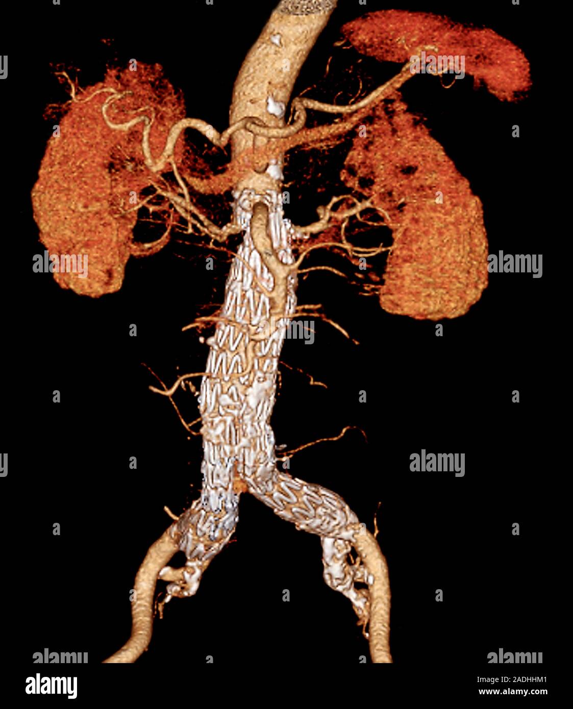 Stent in the abdominal aorta. Coloured 3D computed tomography (CT) scan ...