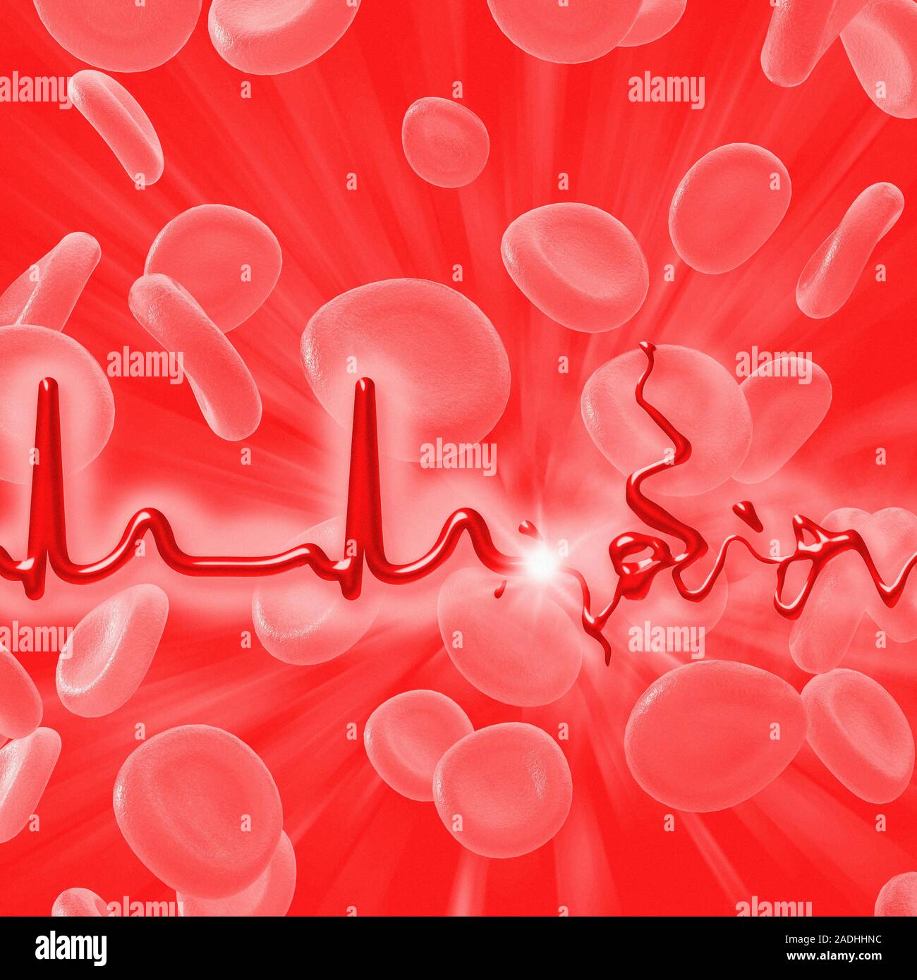 Ruptured blood vessel. Computer artwork of an electrocardiogram (ECG ...