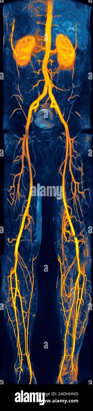 Narrowed leg artery. Magnetic resonance angiography (MRA) scan of the ...