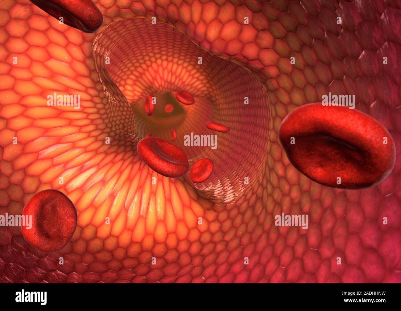 Narrowed artery, computer artwork. Narrowing of the arteries is known ...